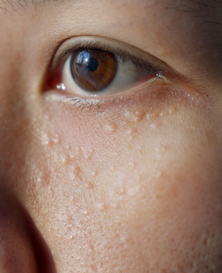 Milia Seed Removal Treatment In Singapore