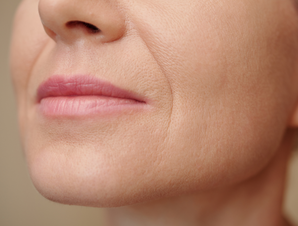 Laugh Line Reduction, Smile Line Treatment In Singapore